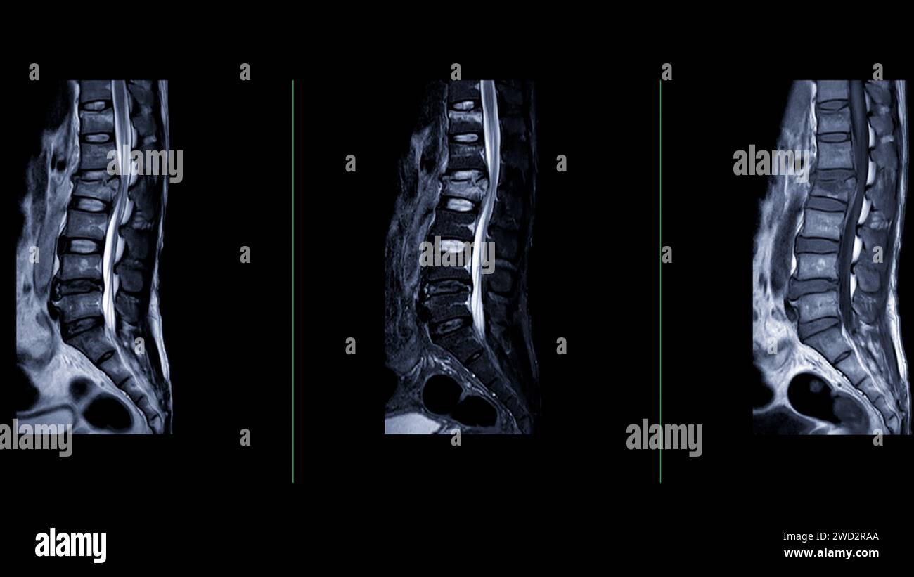 MRI L-S spine or lumbar spine Sagittal view for diagnosis spinal cord ...