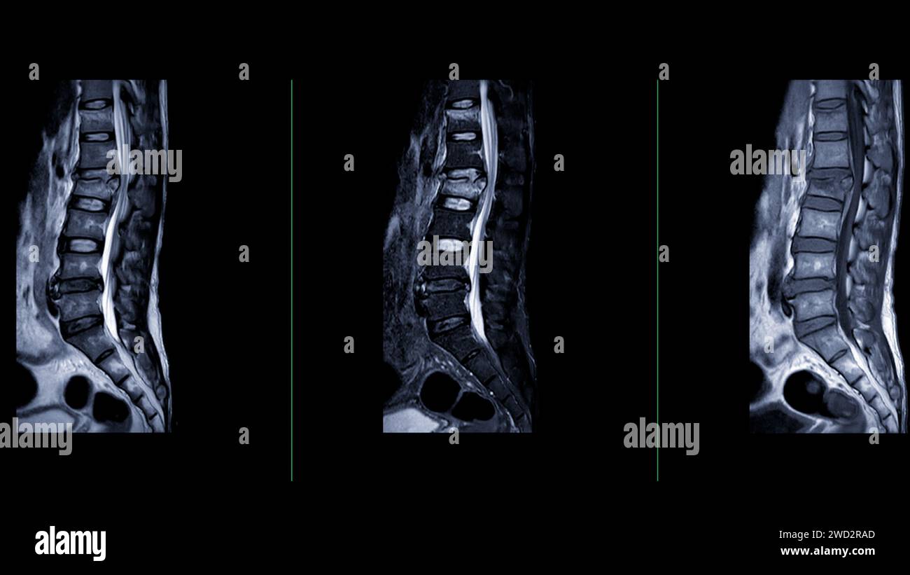 MRI L-S spine or lumbar spine Sagittal view for diagnosis spinal cord ...