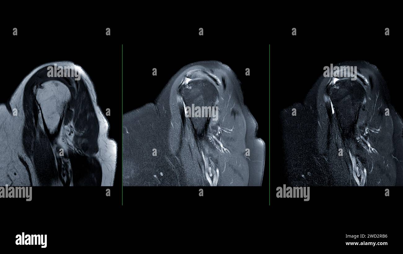 MRI of the shoulder joint sagittal view is a non-invasive imaging ...