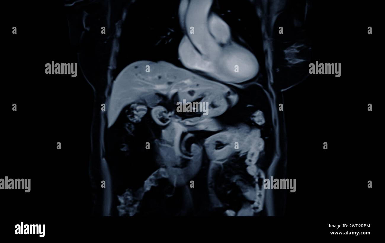 Mri of upper abdomen hi-res stock photography and images - Alamy