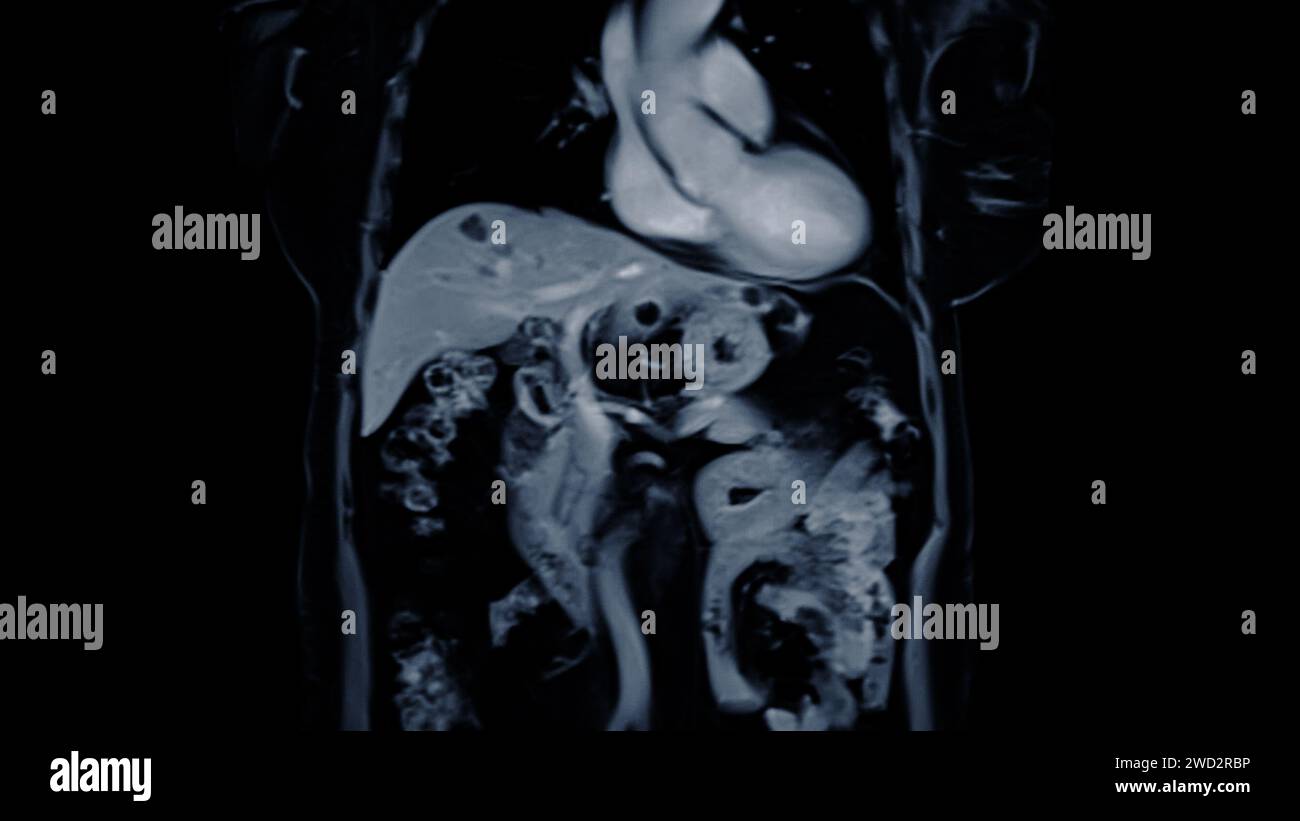 MRI of the upper abdomen coronal view is a non-invasive imaging ...