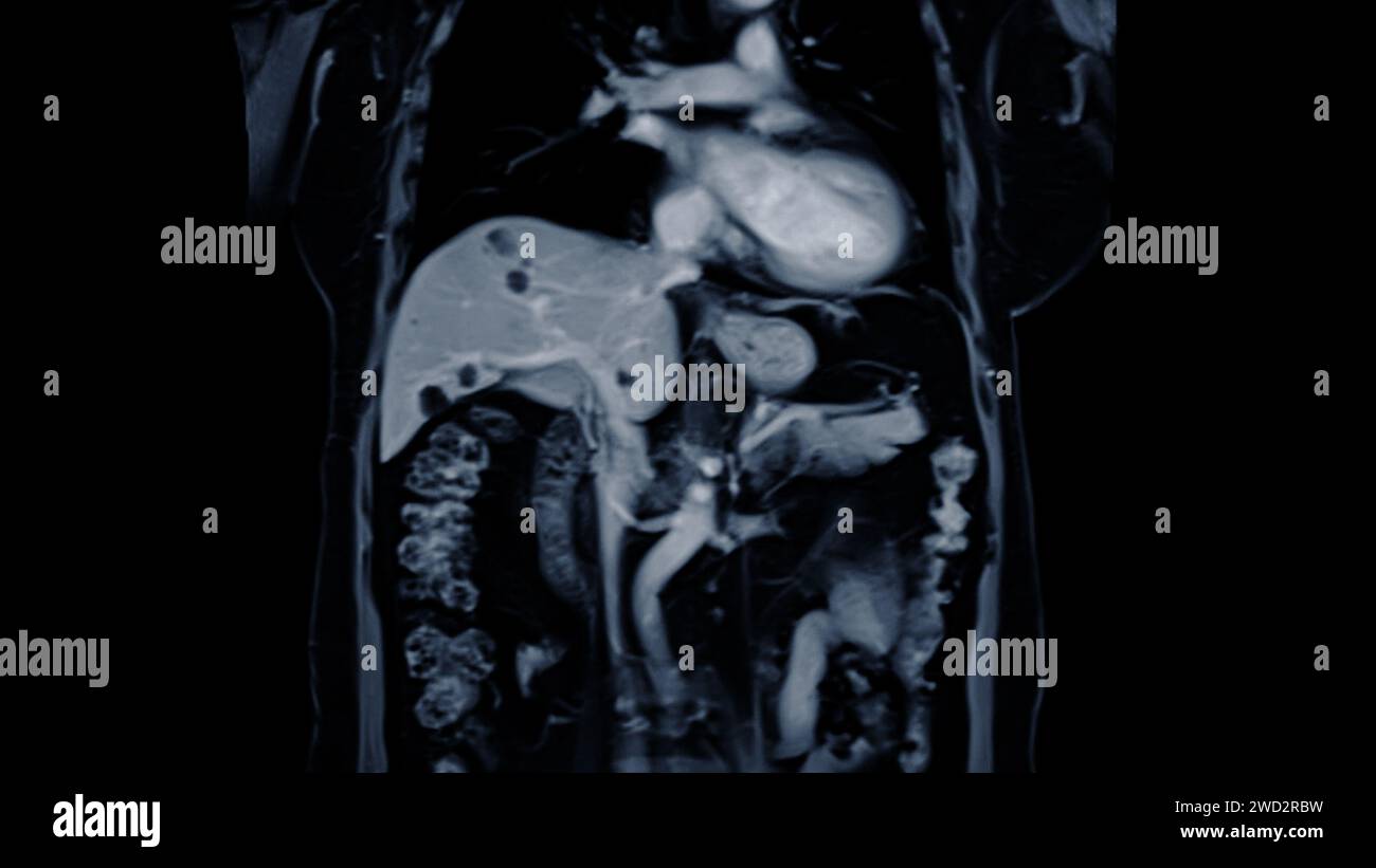 Mri of upper abdomen hi-res stock photography and images - Alamy