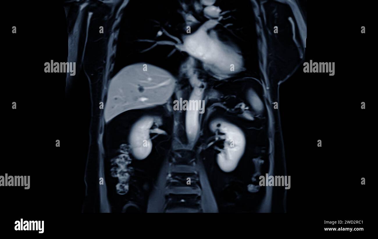 MRI of the upper abdomen coronal view is a non-invasive imaging ...