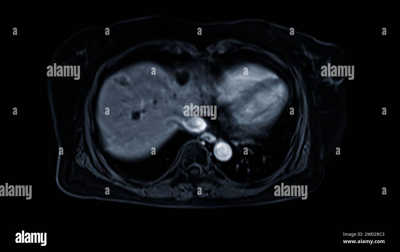 MRI of the upper abdomen axial view is a non-invasive imaging technique ...