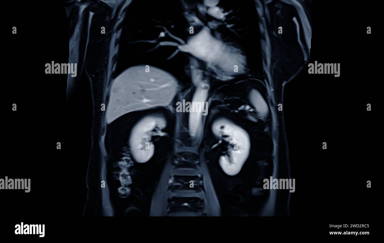 MRI of the upper abdomen coronal view is a non-invasive imaging ...
