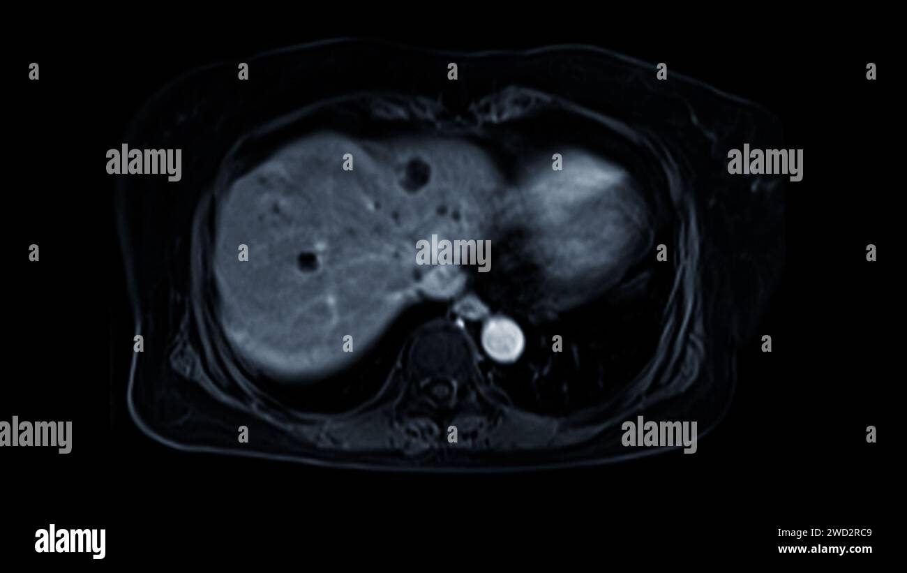 MRI of the upper abdomen axial view is a non-invasive imaging technique ...