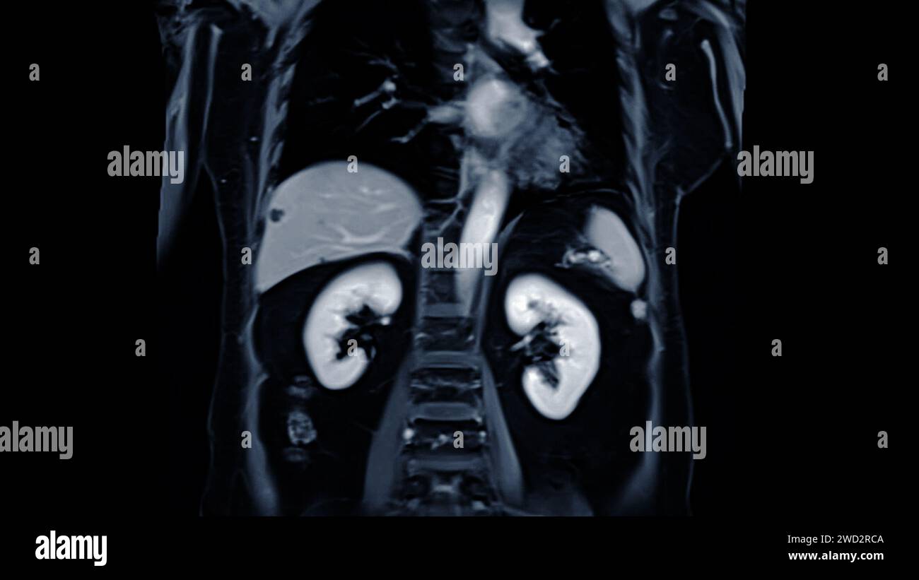 MRI of the upper abdomen coronal view is a non-invasive imaging ...