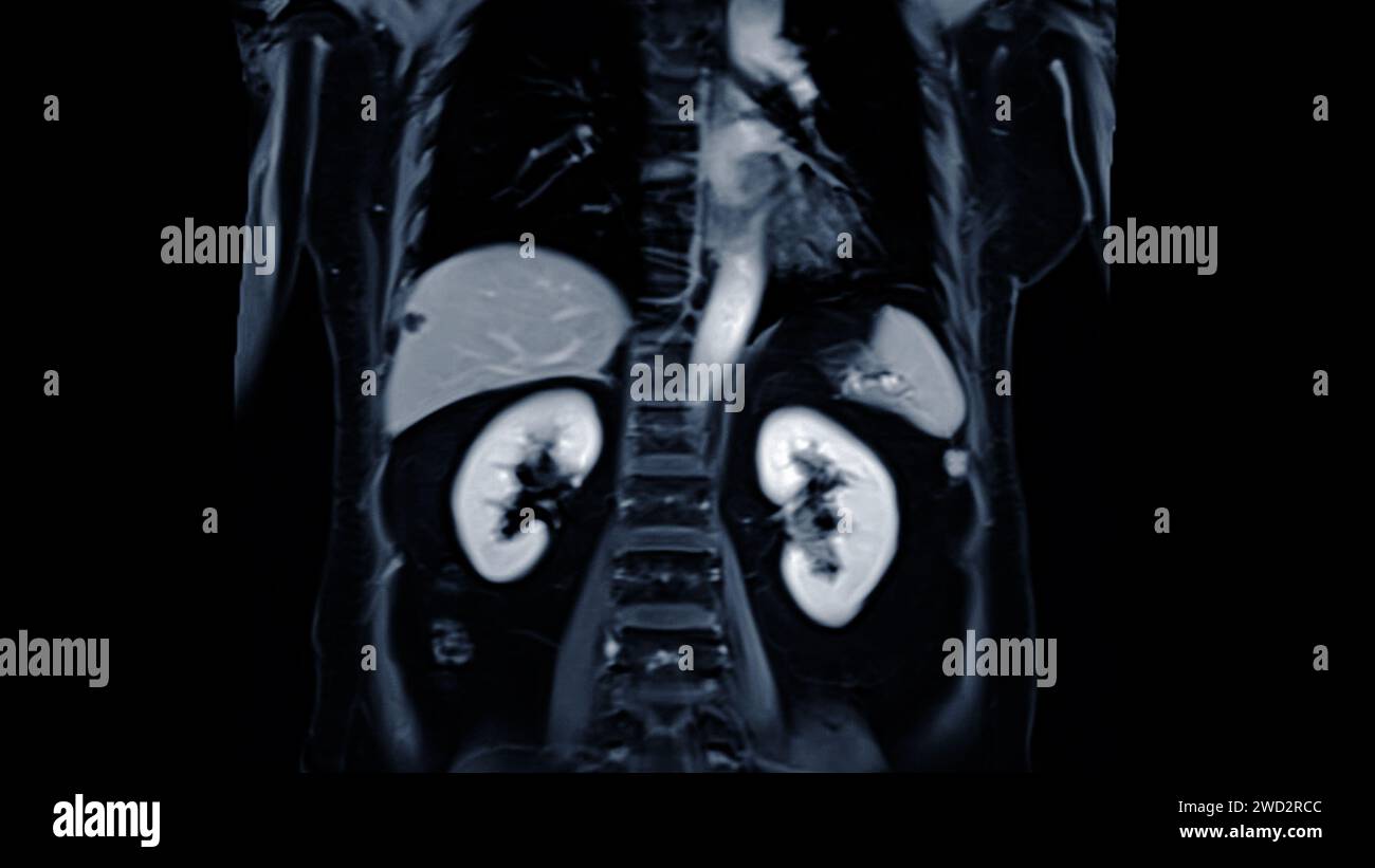 MRI of the upper abdomen coronal view is a non-invasive imaging ...