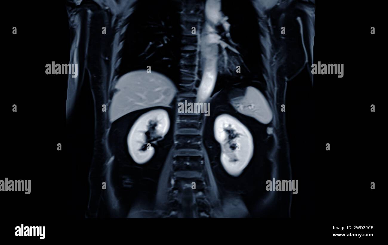 Mri of upper abdomen hi-res stock photography and images - Alamy