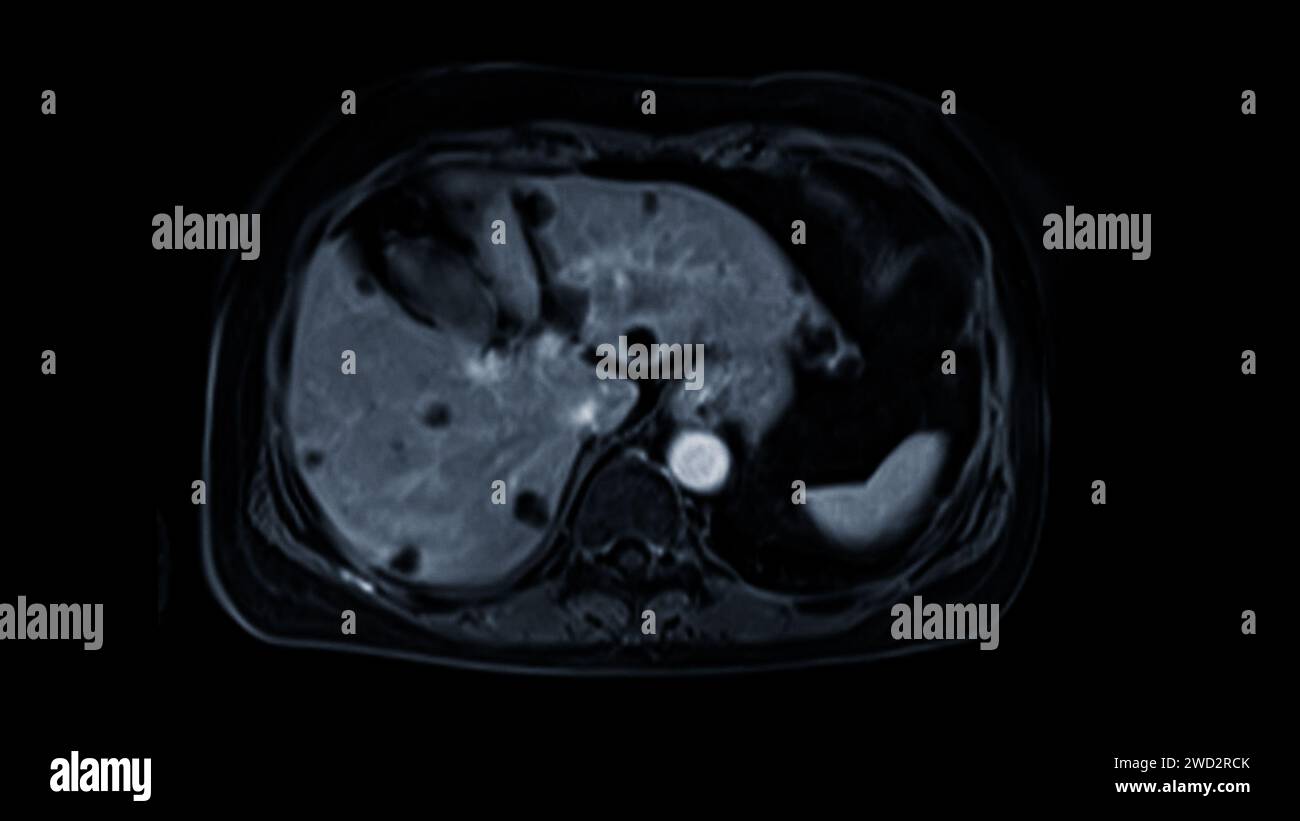 MRI of the upper abdomen axial view is a non-invasive imaging technique ...
