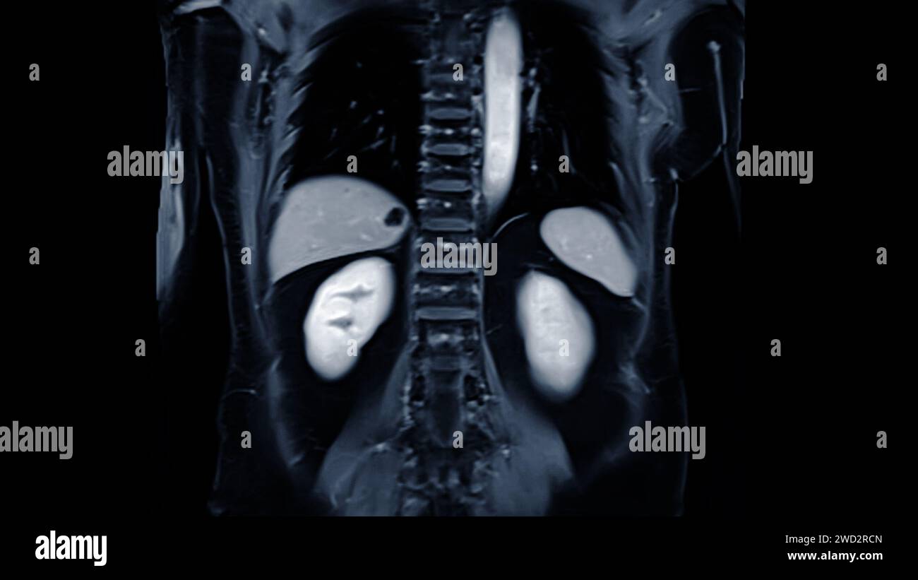 MRI of the upper abdomen coronal view is a non-invasive imaging ...