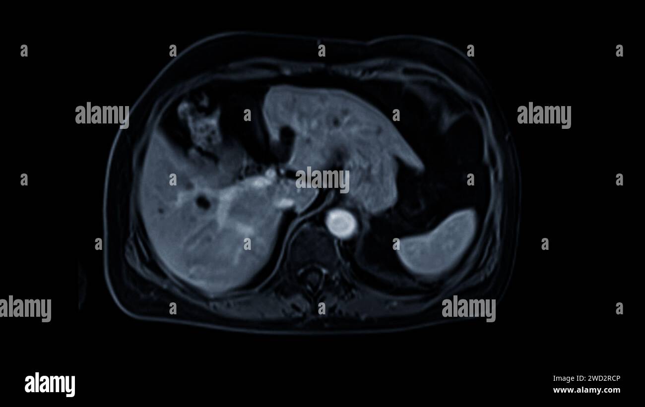 MRI of the upper abdomen axial view is a non-invasive imaging technique ...