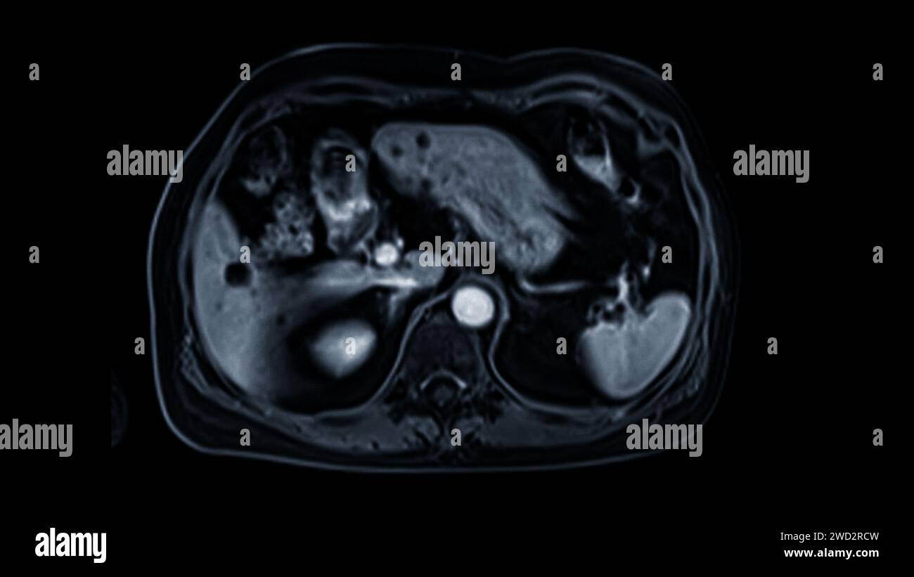 MRI of the upper abdomen axial view is a non-invasive imaging technique ...