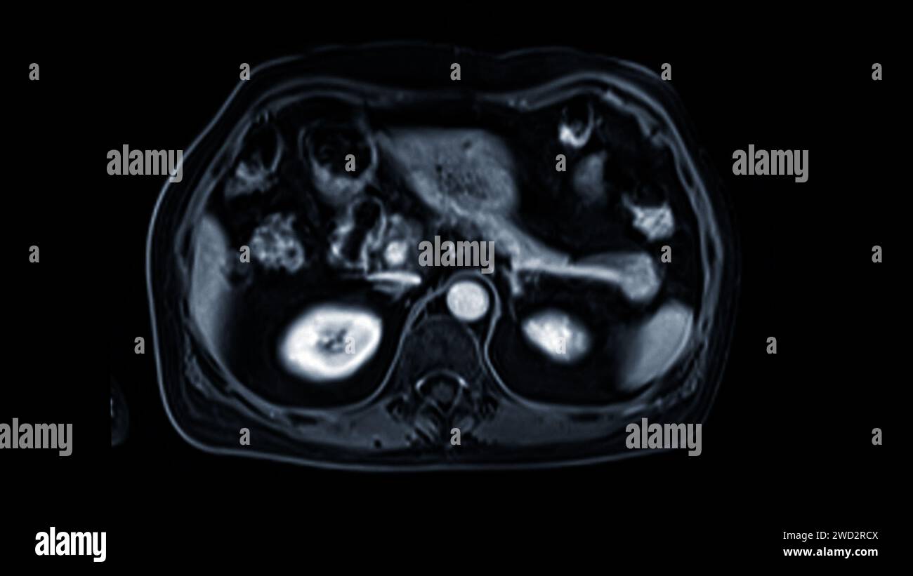 MRI of the upper abdomen axial view is a non-invasive imaging technique ...