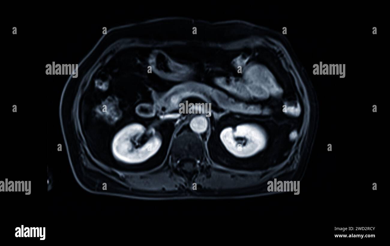 MRI of the upper abdomen axial view is a non-invasive imaging technique ...