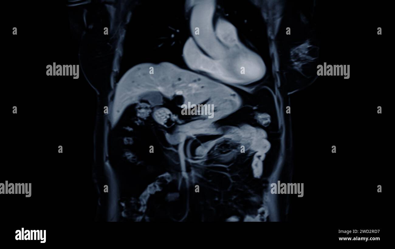 MRI of the upper abdomen coronal view is a non-invasive imaging ...