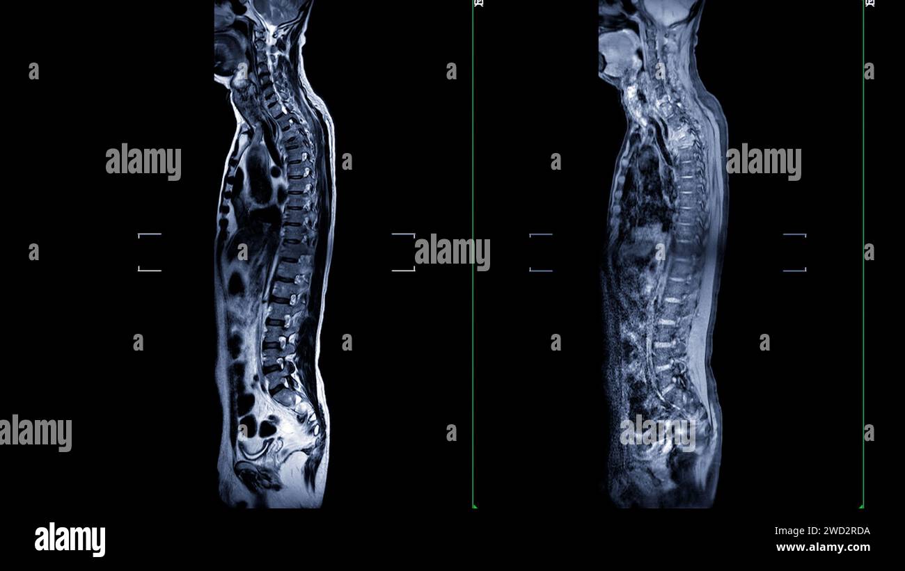 An MRI of the whole spine image is a comprehensive visual ...