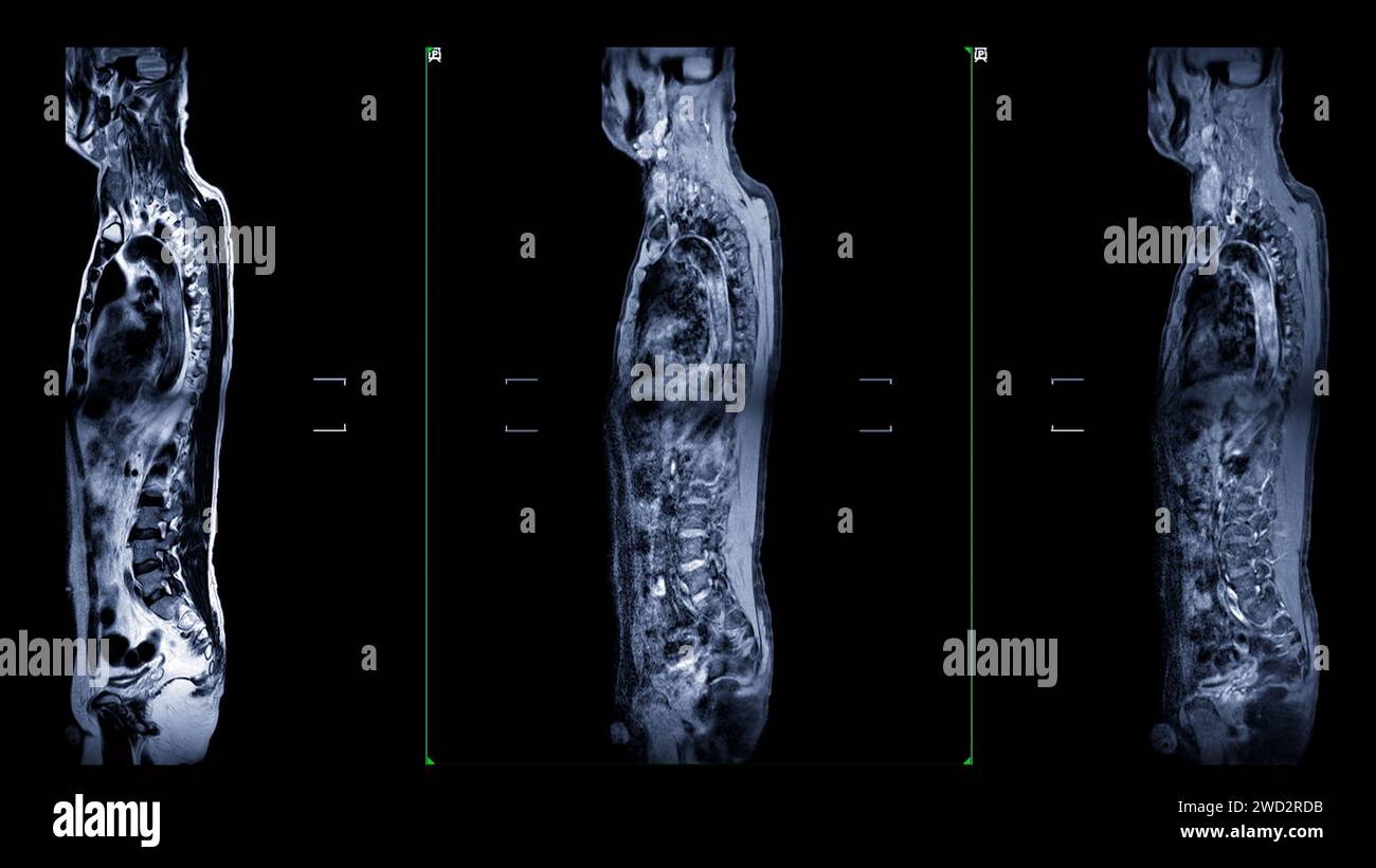 An MRI of the whole spine image is a comprehensive visual ...