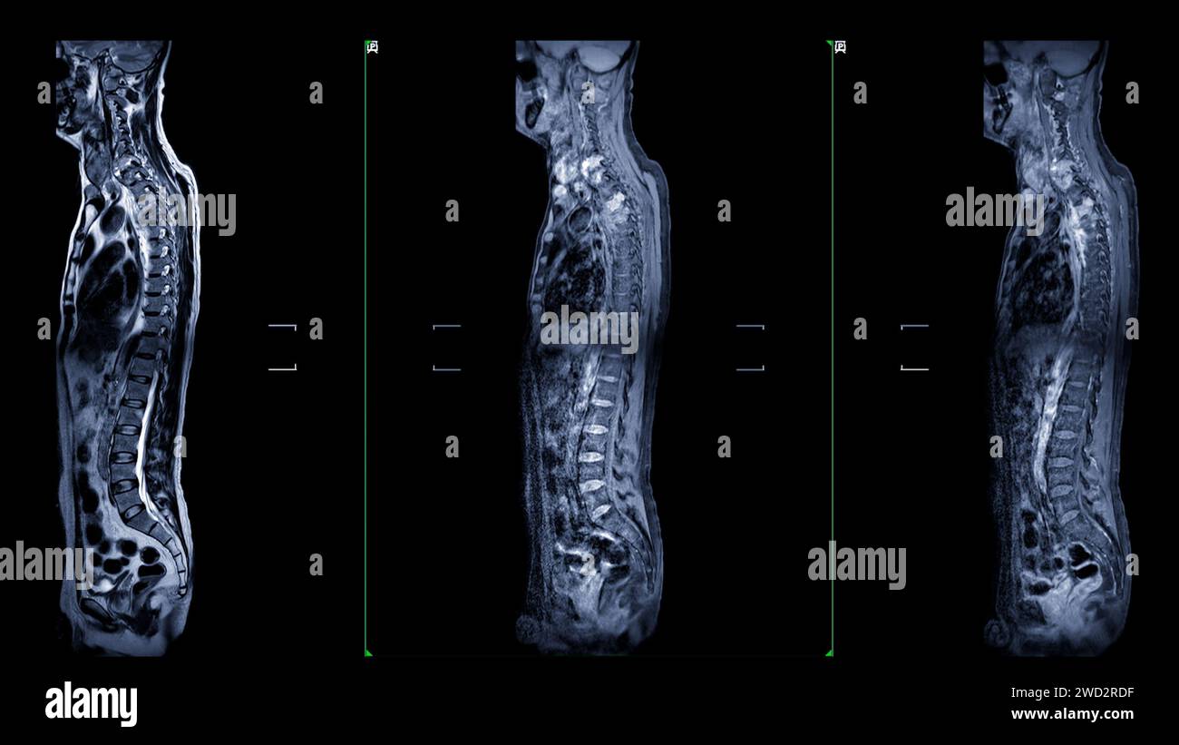 An MRI of the whole spine image is a comprehensive visual ...