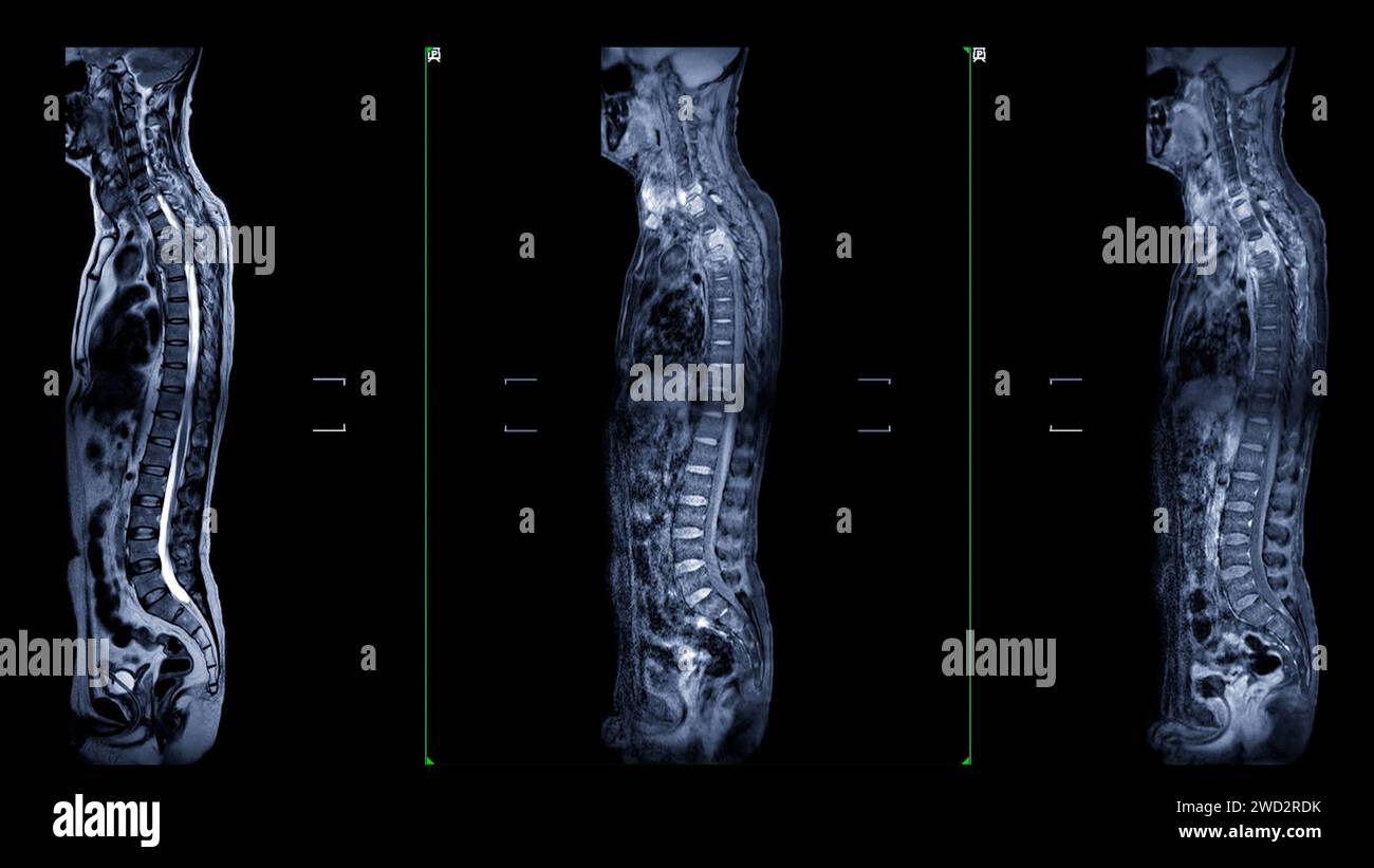 An MRI of the whole spine image is a comprehensive visual representation produced through ...