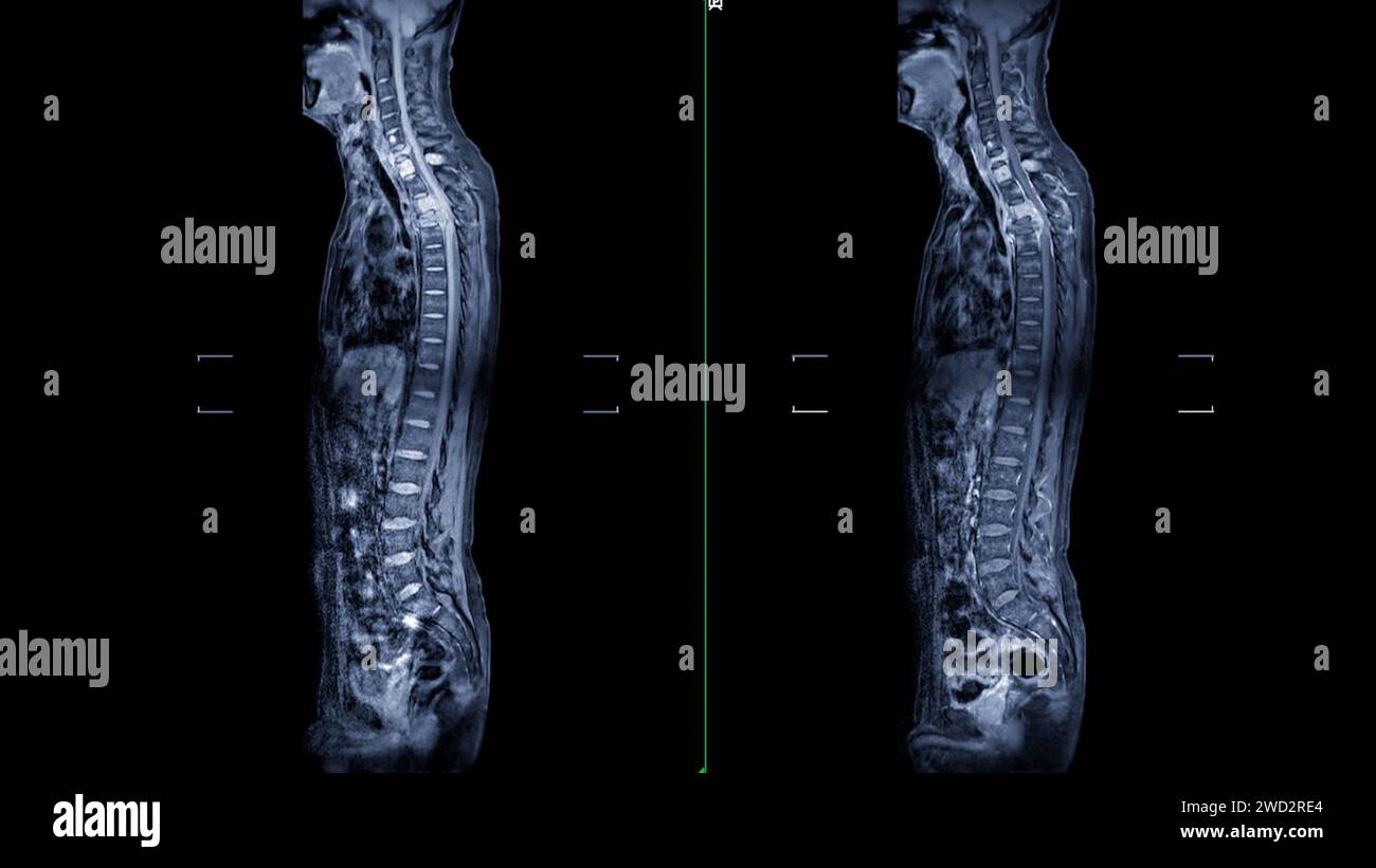 An MRI of the whole spine image is a comprehensive visual ...