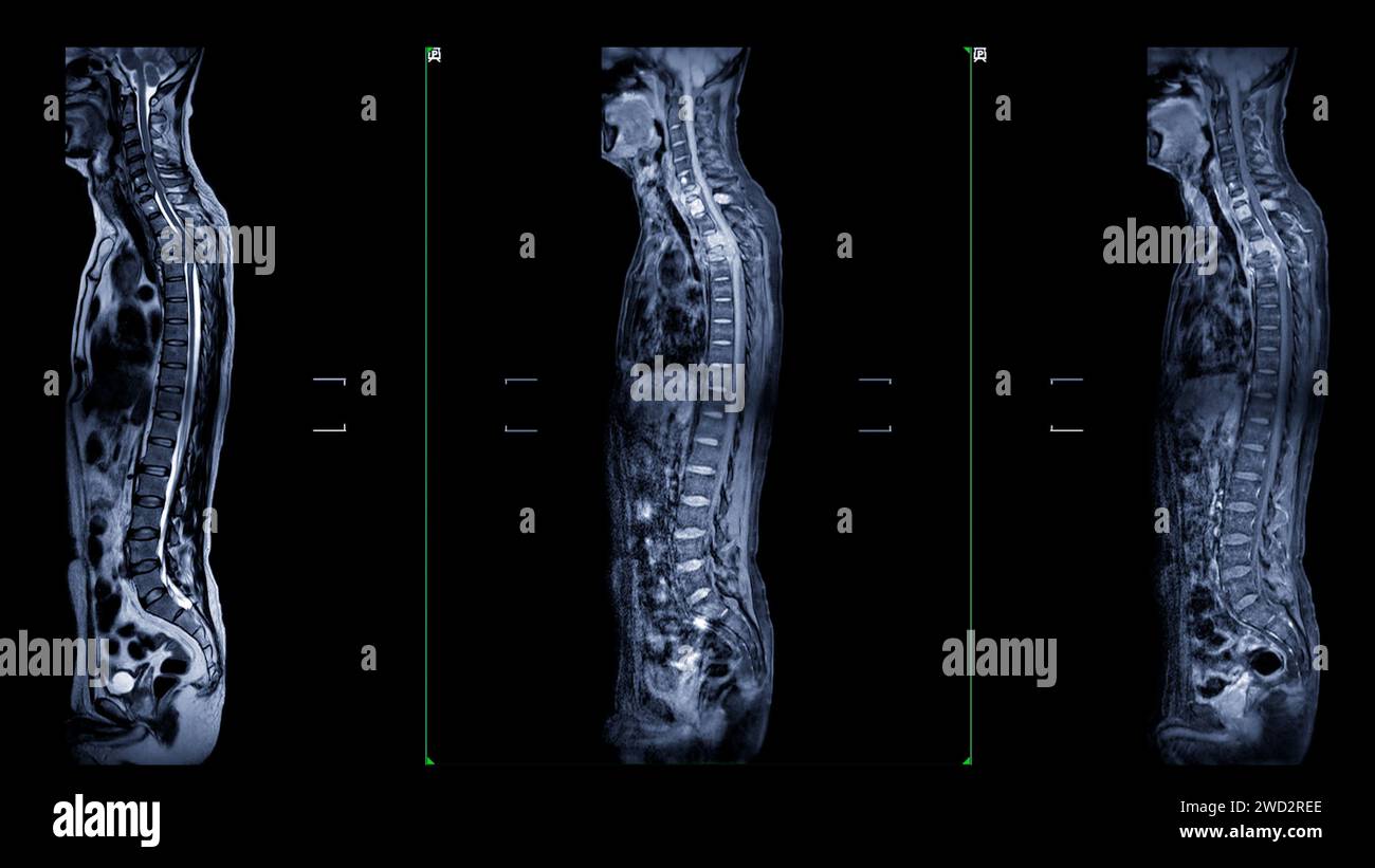 An MRI of the whole spine image is a comprehensive visual representation produced through ...