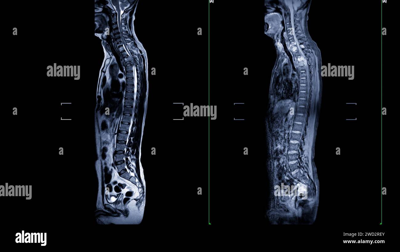 An MRI of the whole spine image is a comprehensive visual ...