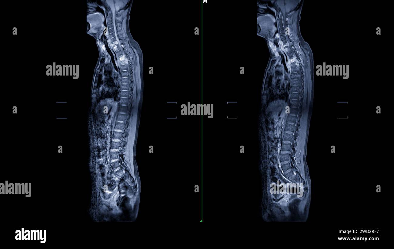 An MRI of the whole spine image is a comprehensive visual representation produced through ...
