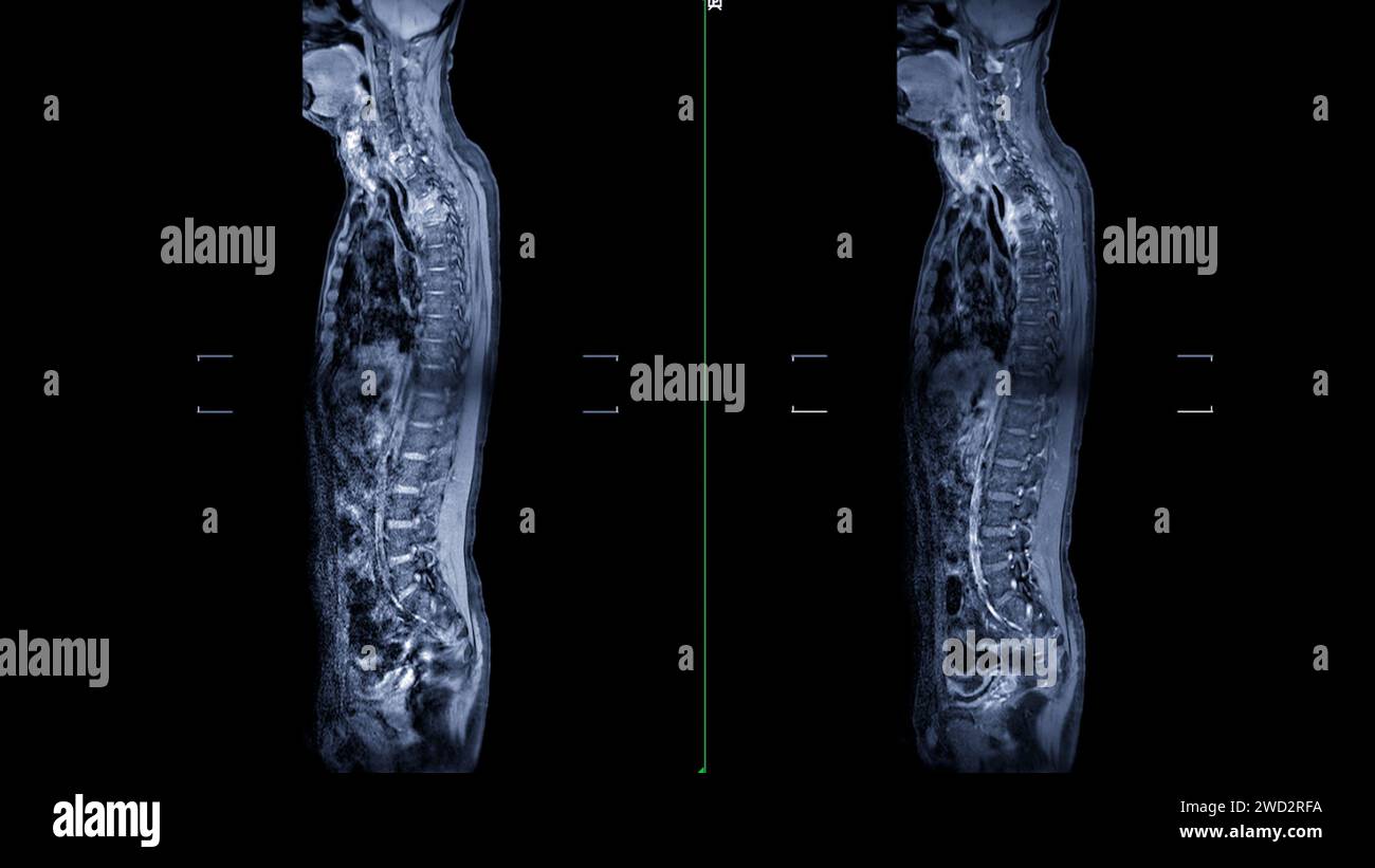 An MRI of the whole spine image is a comprehensive visual ...