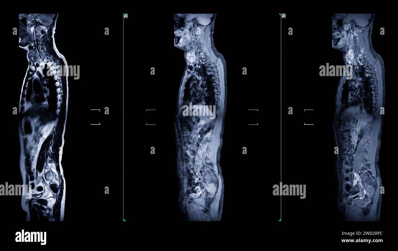 Herniations hi-res stock photography and images - Alamy