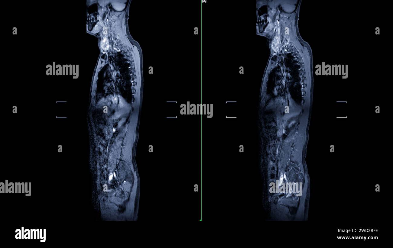 An MRI of the whole spine image is a comprehensive visual ...