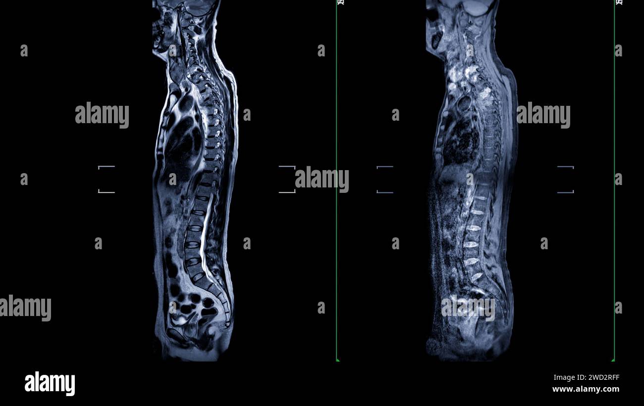 Herniations hi-res stock photography and images - Alamy