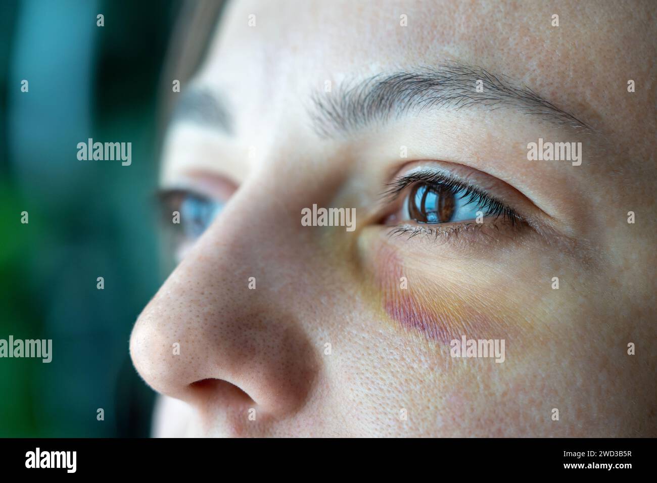 Beaten up woman face with bruise black eye after victim of domestic ...