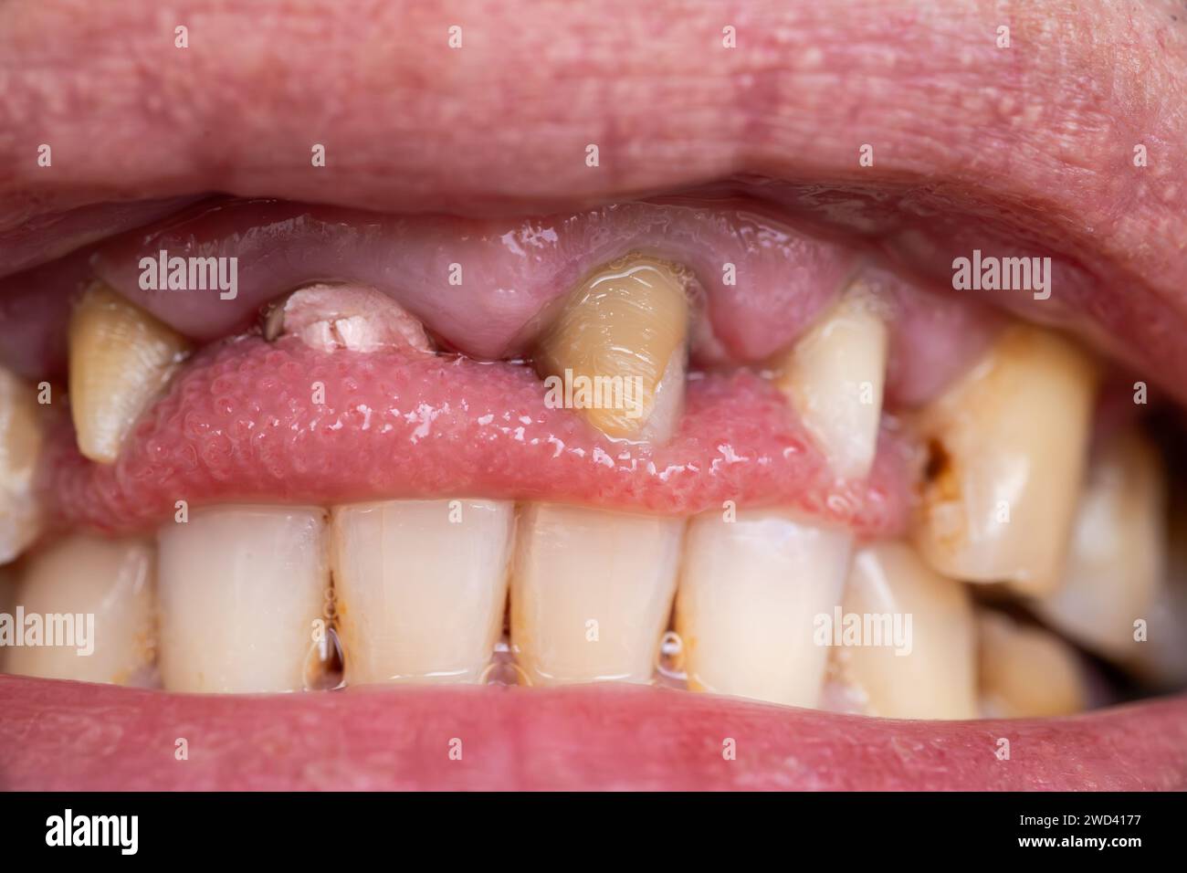 Broken tooth, missing teeth in open human mouth close up macro photo ...