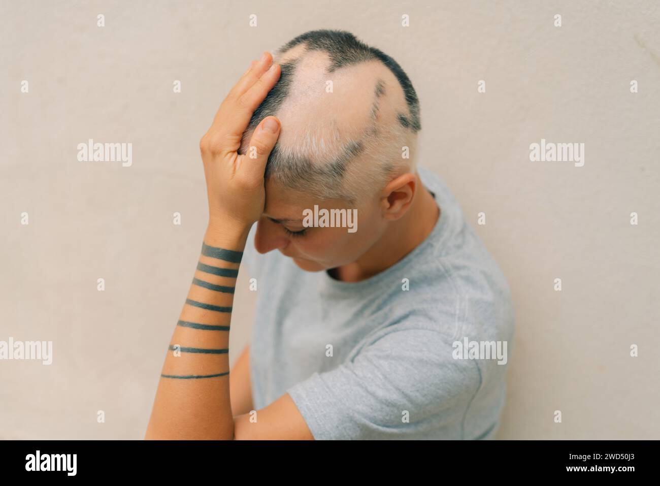 Real alopecia areata in a young girl. A bald head in a person. Diffuse ...