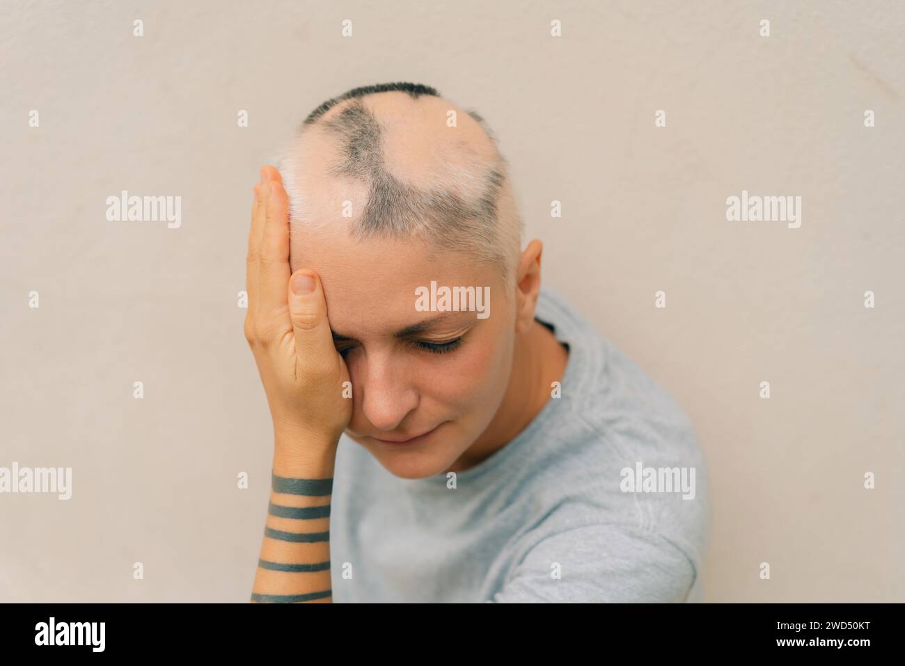 Real alopecia areata in a young girl. A bald head in a person. Diffuse ...