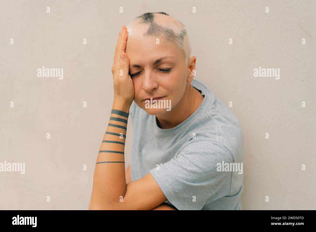 Real Alopecia Areata In A Young Girl A Bald Head In A Person Diffuse Alopecia Androgenic