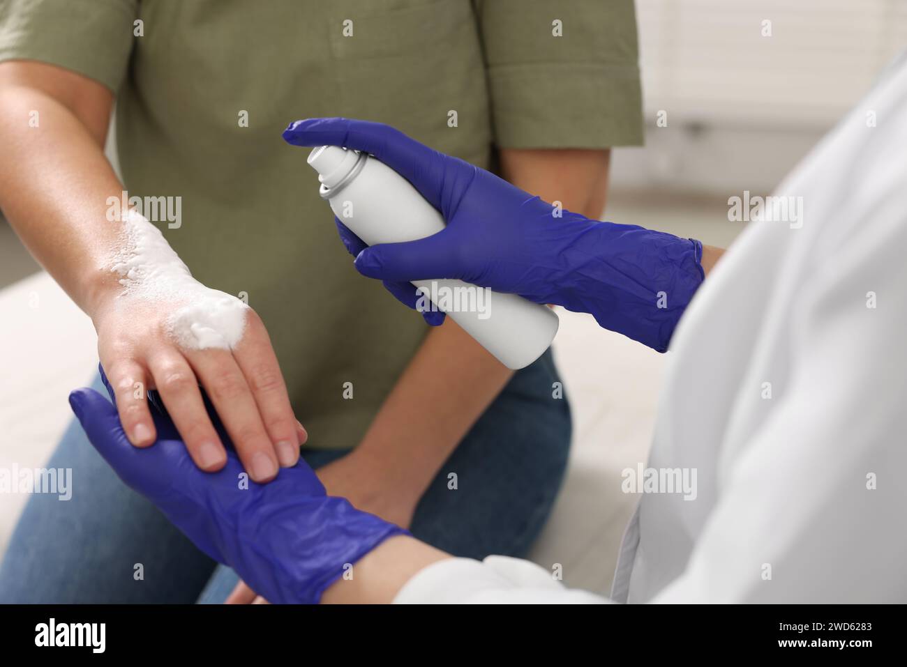 Doctor applying panthenol onto patient's burned hand in clinic, closeup ...