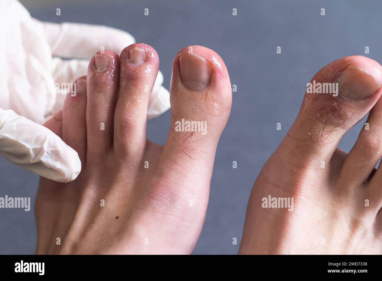 A white man holding his toes, showing what looks like a rash with red ...