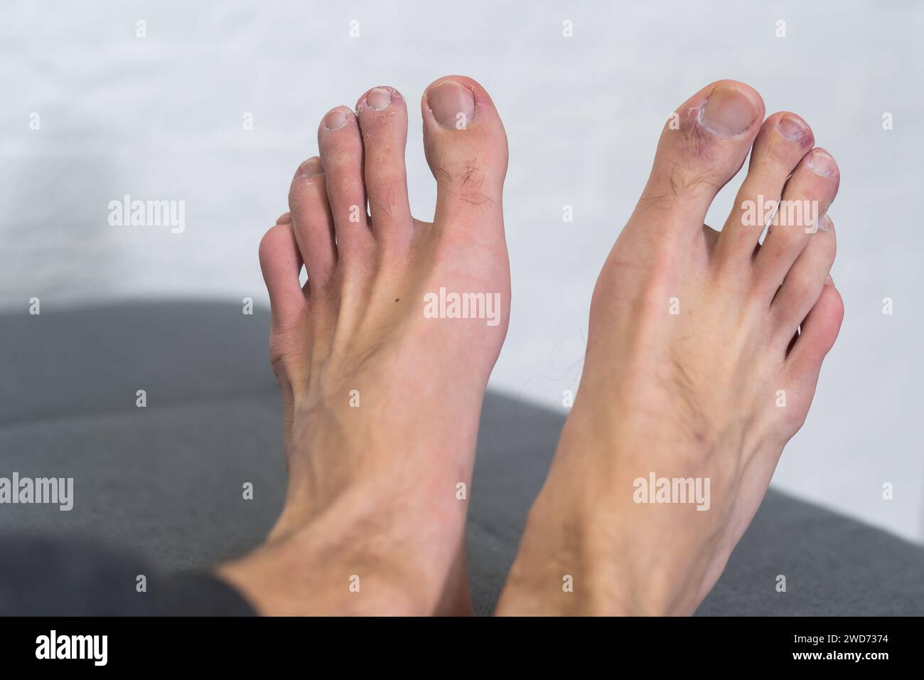 A man's toes showing what looks like a rash with red blotchy skin. A ...