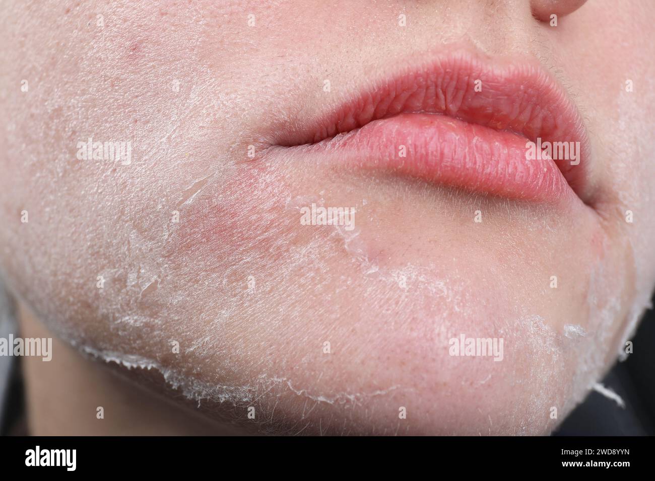 Woman pores chin hi-res stock photography and images - Alamy
