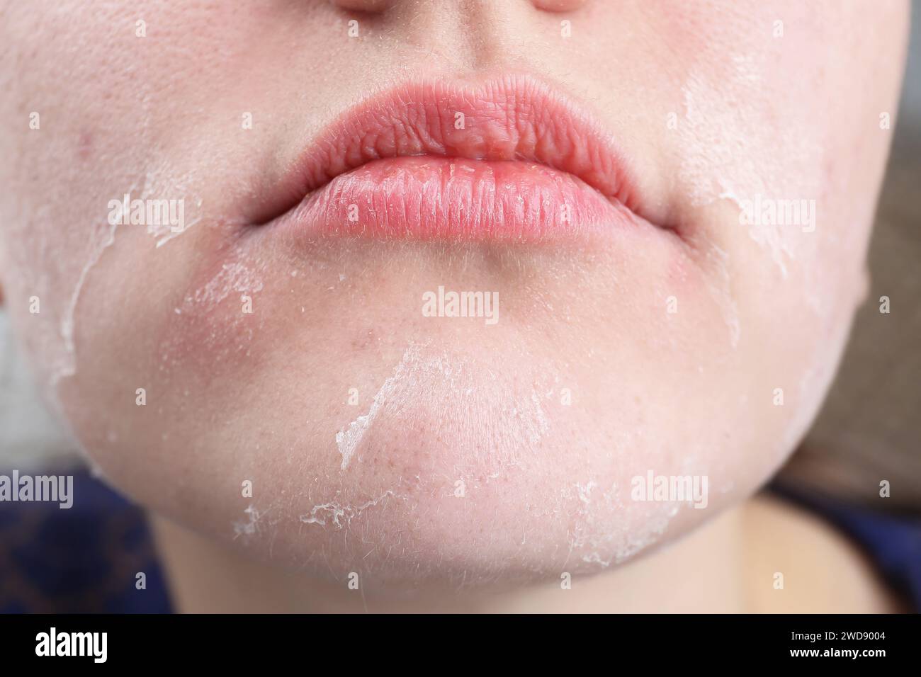 Shedding skin human hi-res stock photography and images - Alamy