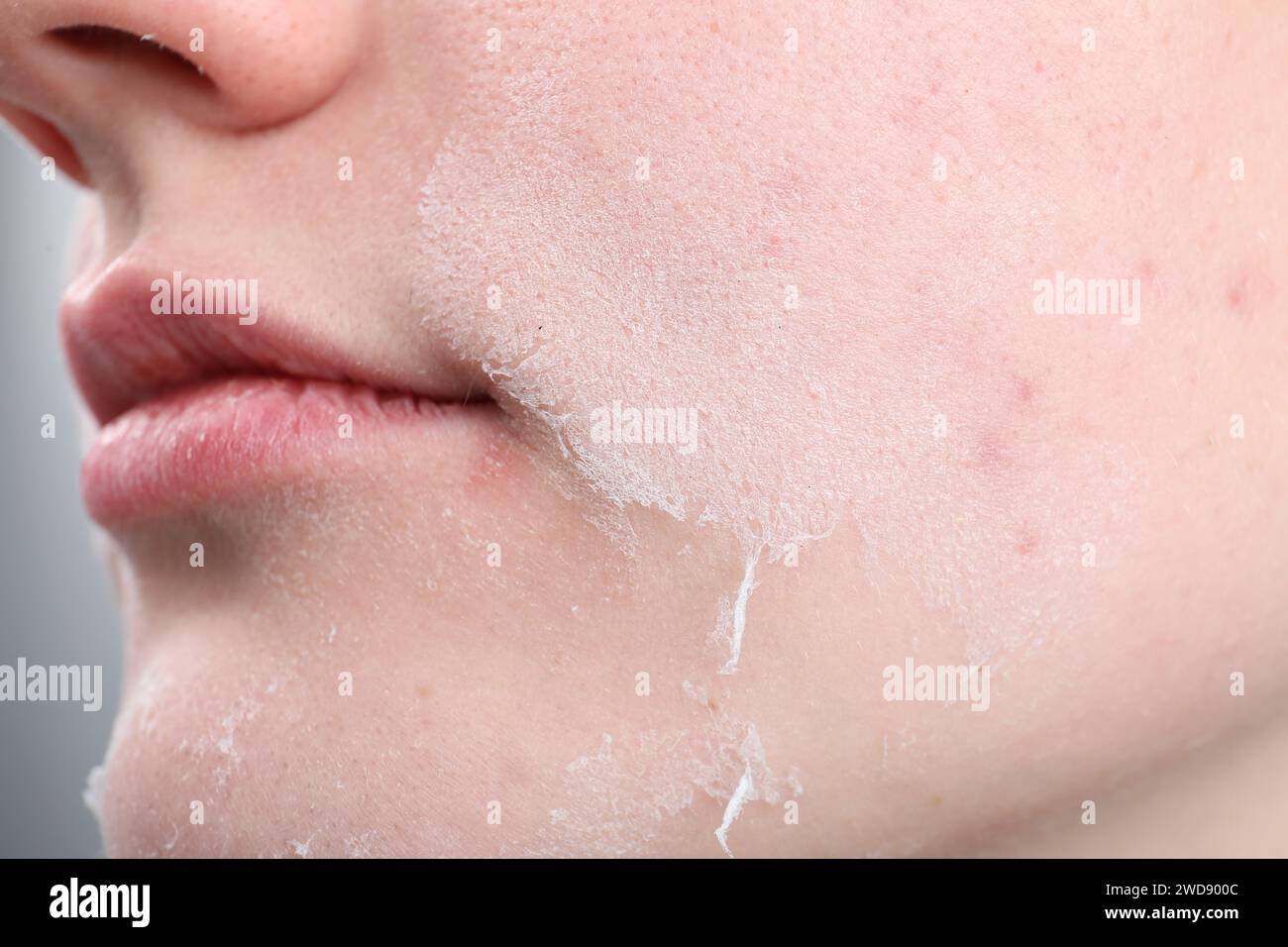 Dry skin face peeling hi-res stock photography and images - Alamy