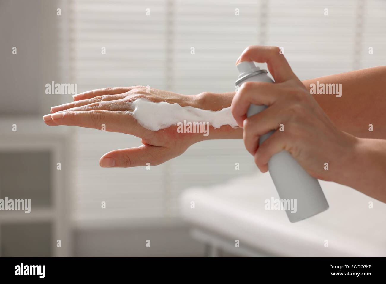Chemical burn hand hi-res stock photography and images - Alamy