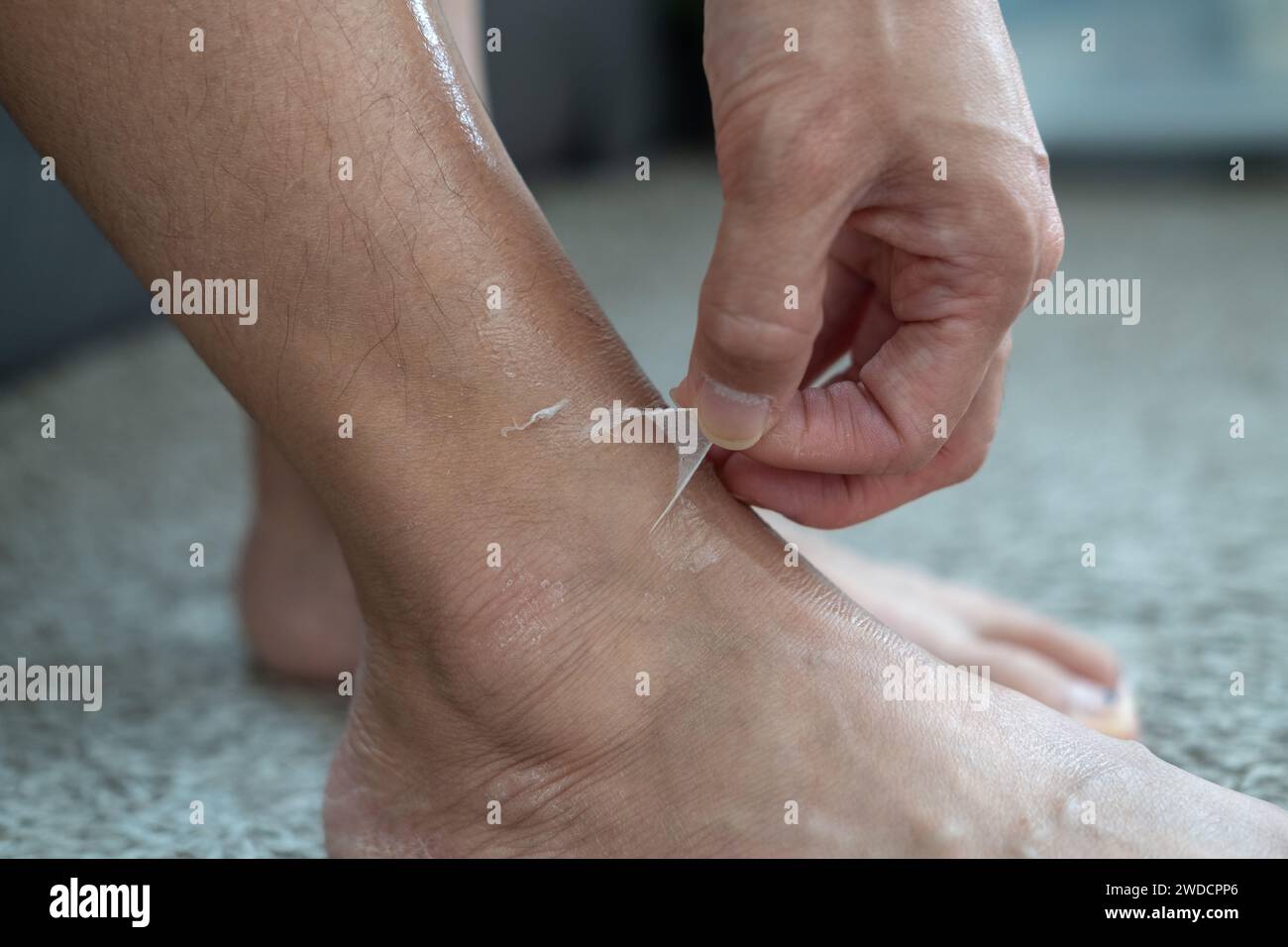 A woman's hand is peeling away dry skin. skin problems Stock Photo - Alamy