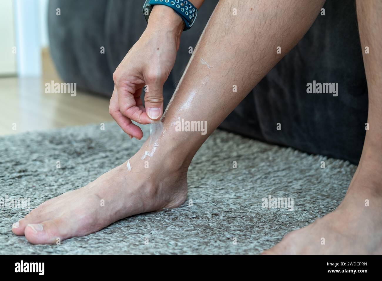 A woman's hand is peeling away dry skin. skin problems Stock Photo - Alamy