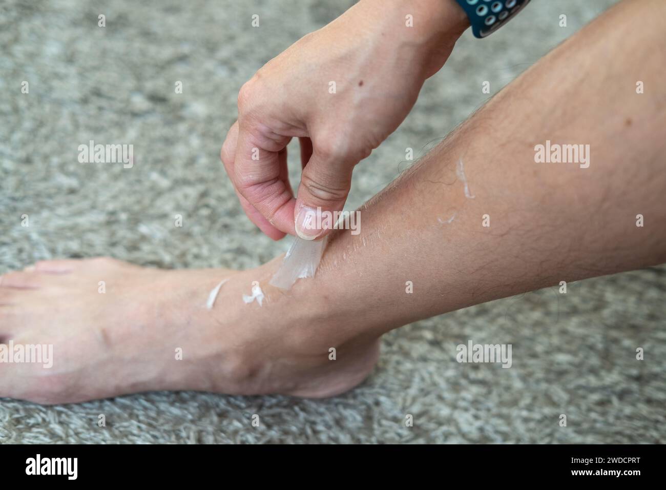 A woman's hand is peeling away dry skin. skin problems Stock Photo - Alamy