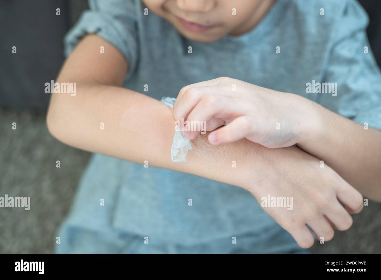 Little Asian boy's hands peeling off dry skin on his arm. Skin problems ...