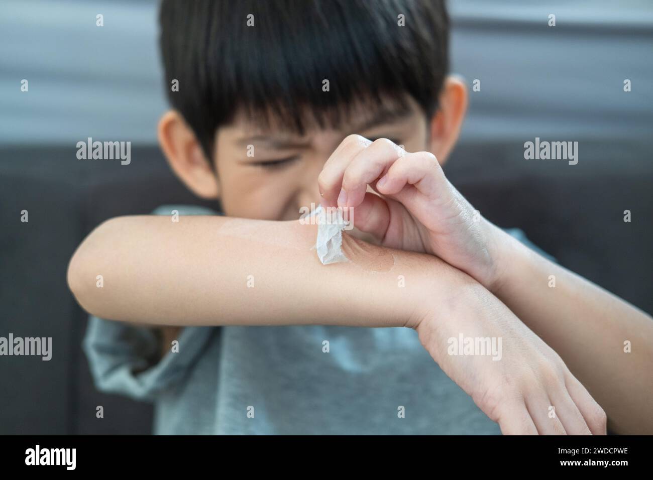 Little Asian boy's hands peeling off dry skin on his arm. Skin problems ...