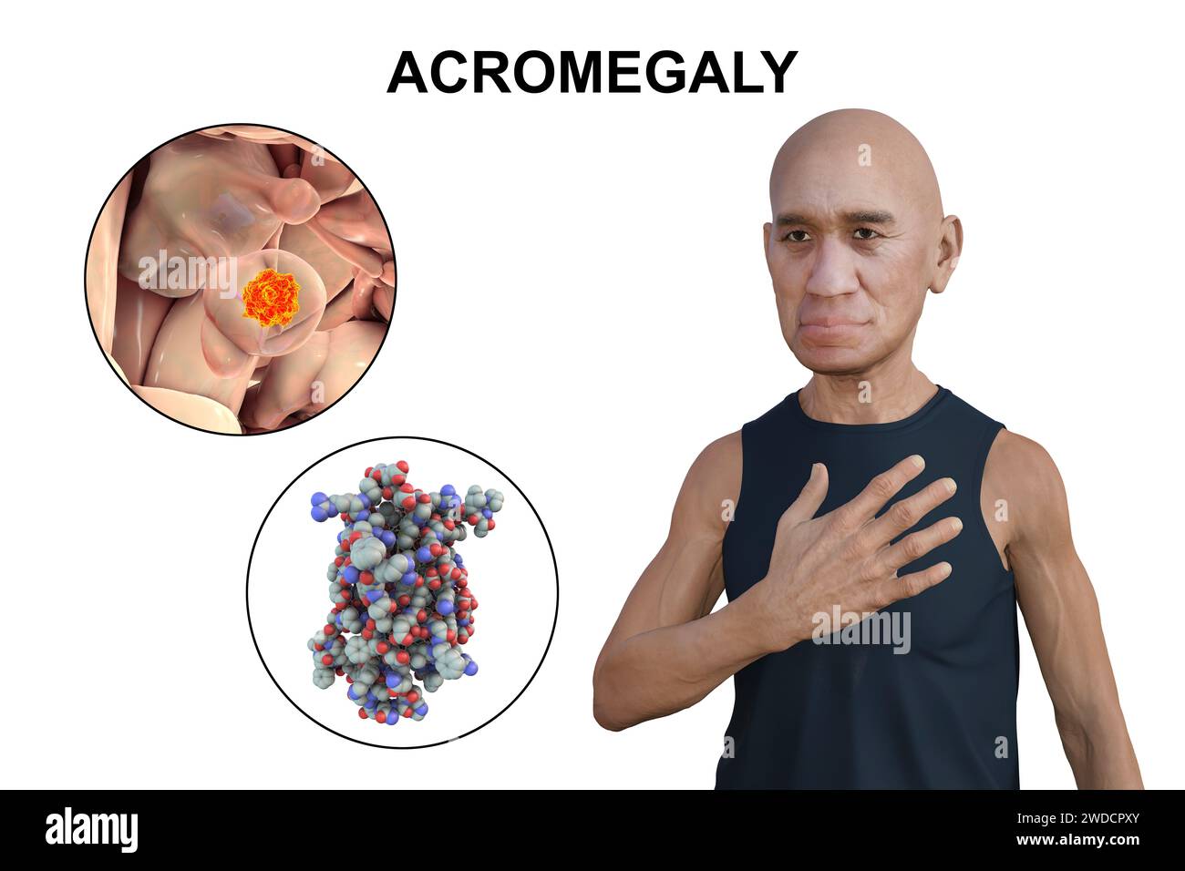 Acromegaly hi-res stock photography and images - Alamy